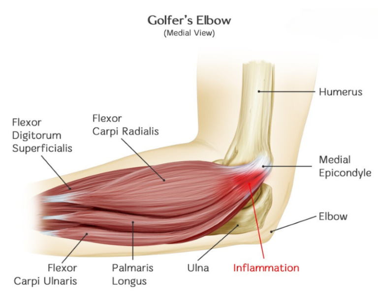 Golfer’s Elbow: Causes, Symptoms, Treatment, and Prevention – Lowton Physio & Sports Injury Clinic
