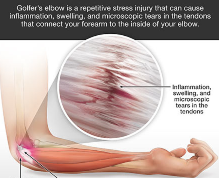 Golfer’s Elbow: Causes, Symptoms, Treatment, and Prevention – Lowton ...
